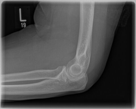 Fettpolsterzeichen am Ellenbogen